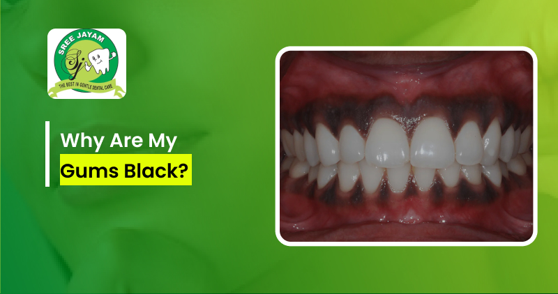 Why Are My Gums Black | How to Get Rid of Black Gums