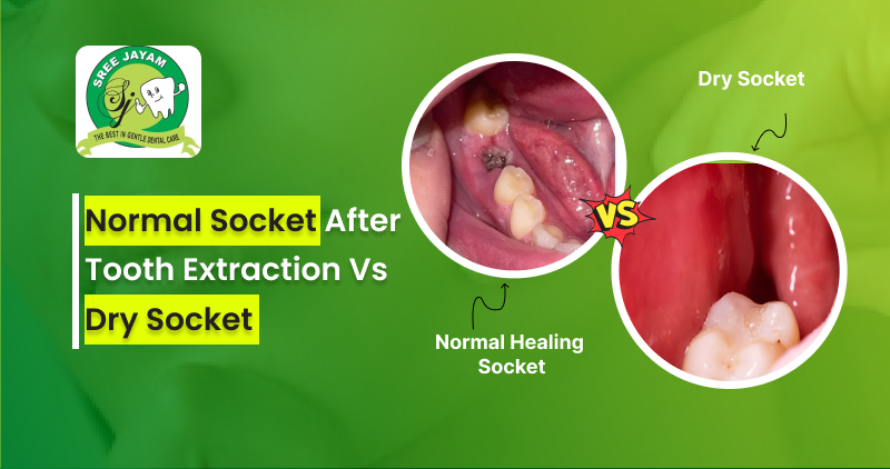 Normal Socket After Tooth Extraction vs Dry Socket | Pictures of Dry ...